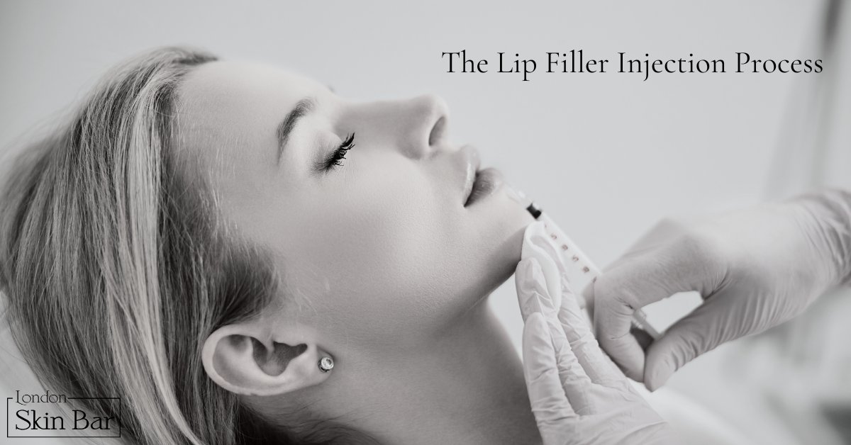 Everything You Need to Know About Lip Filler Injections | London Skin Bar